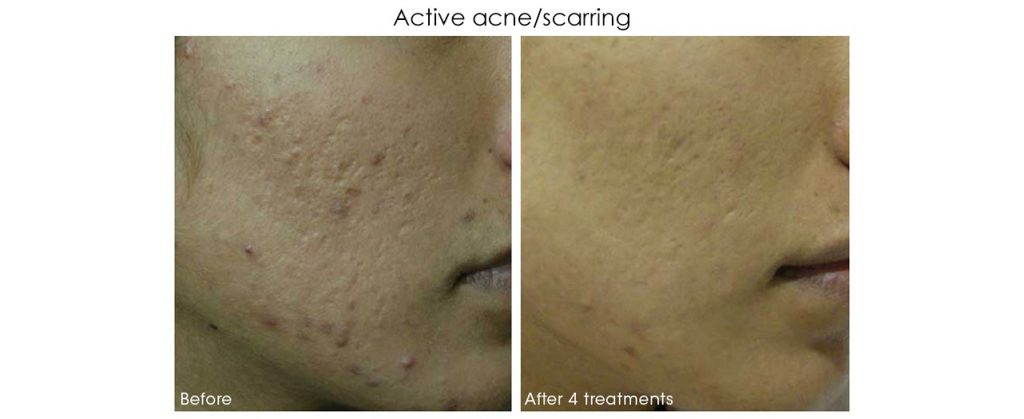 eDermastamp Micro-needling | Fayez Spa