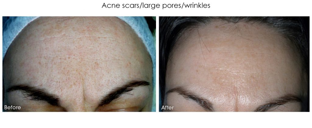 eDermastamp Micro-needling | Fayez Spa