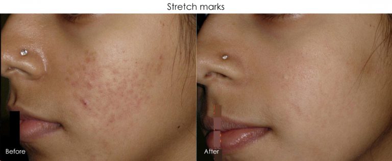 eDermastamp Micro-needling | Fayez Spa