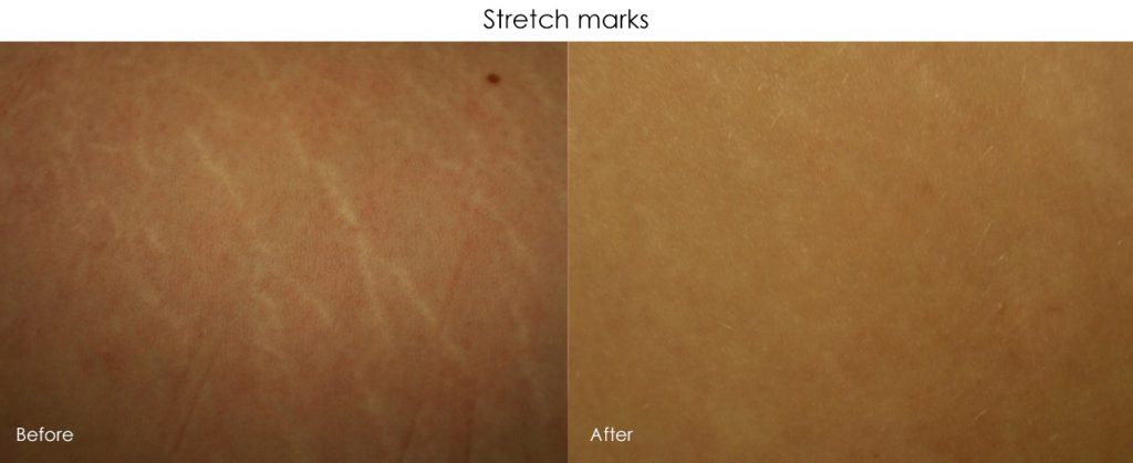 eDermastamp Micro-needling | Fayez Spa